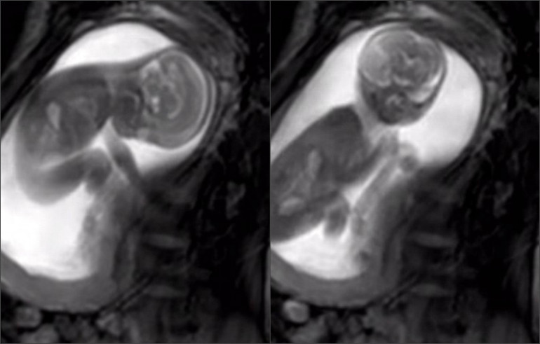 Womb with a view! Breathtaking new 20-week MRI scan lets expectant ...